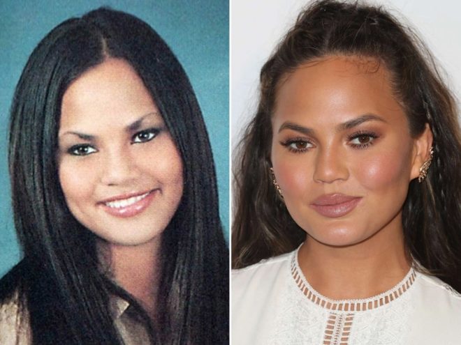 Chrissy Teigen Before and After Plastic Surgery: cheeks, nose, lips, teeth