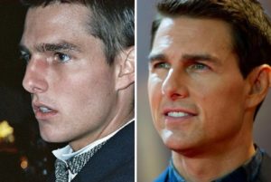 Tom Cruise Before and After Plastic Surgery: Face, Nose, Teeth