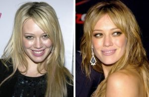 Hilary Duff Before and After Plastic Surgery: Boob, Nose, Lips