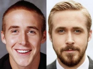 Ryan Gosling Before and After Plastic Surgery: Nose, Teeth