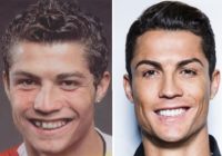 Cristiano Ronaldo Before and After Plastic Surgery
