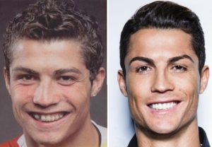 Cristiano Ronaldo Before and After Plastic Surgery