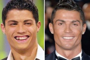 Cristiano Ronaldo Before and After Plastic Surgery