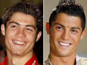 Cristiano Ronaldo Before and After Plastic Surgery