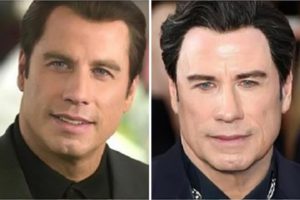 John Travolta Before and After Plastic Surgery