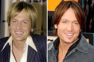 Keith Urban Before and After Plastic Surgery: Nose, Teeth, Botox