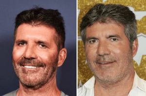 Simon Cowell Before and After Plastic Surgery: Facelift, Botox