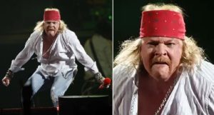 Axl Rose Before and After Plastic Surgery: Facelift, Botox