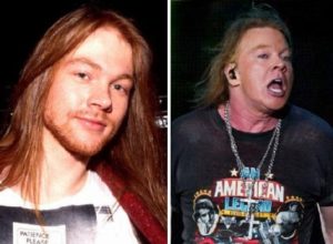 Axl Rose Before and After Plastic Surgery: Facelift, Botox