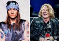 Axl Rose Before and After Plastic Surgery: Facelift, Botox