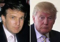 Donald Trump Before and After Plastic Surgery: Face, Hair, Body